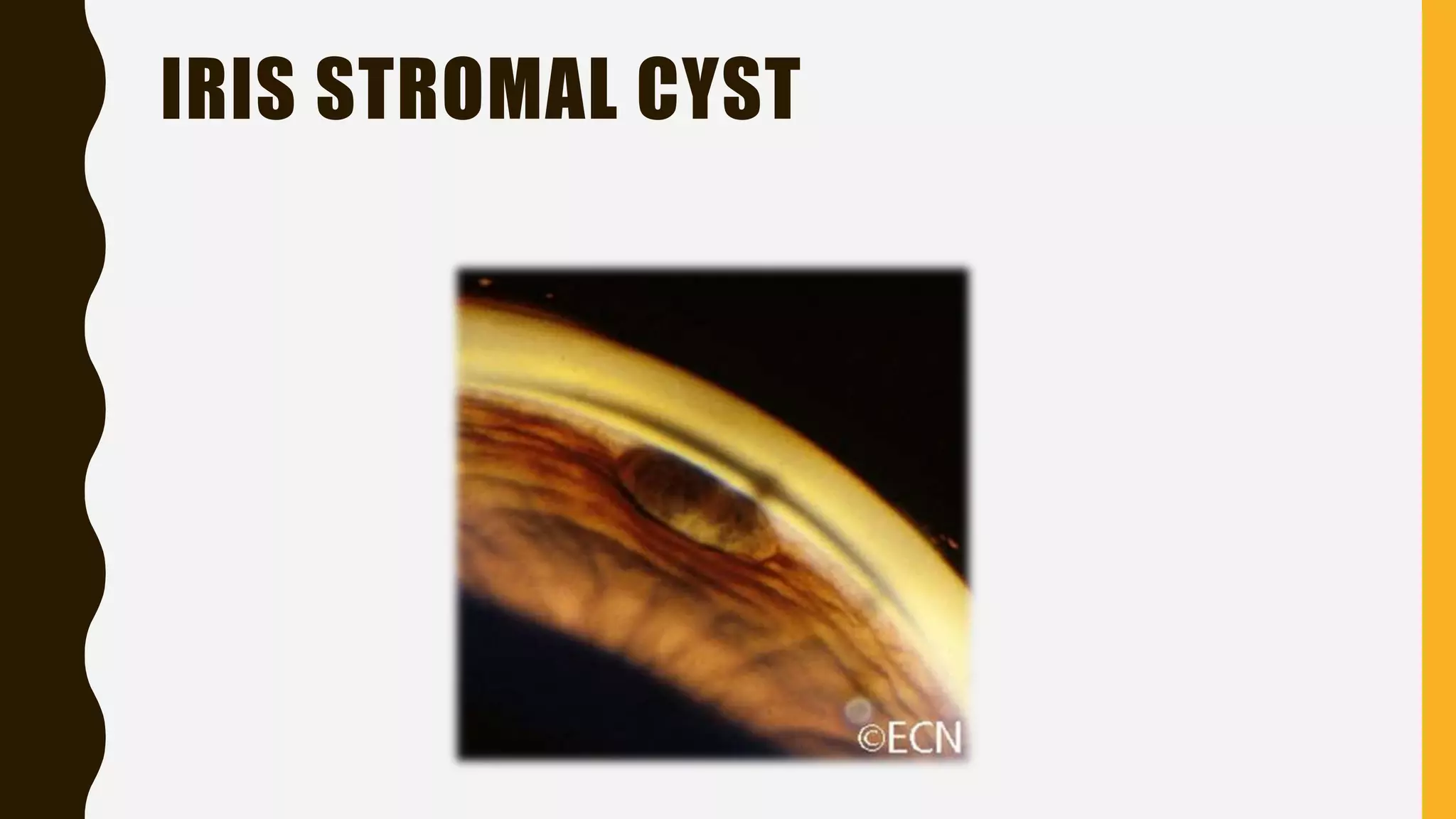 Gonioscopy | PPTX