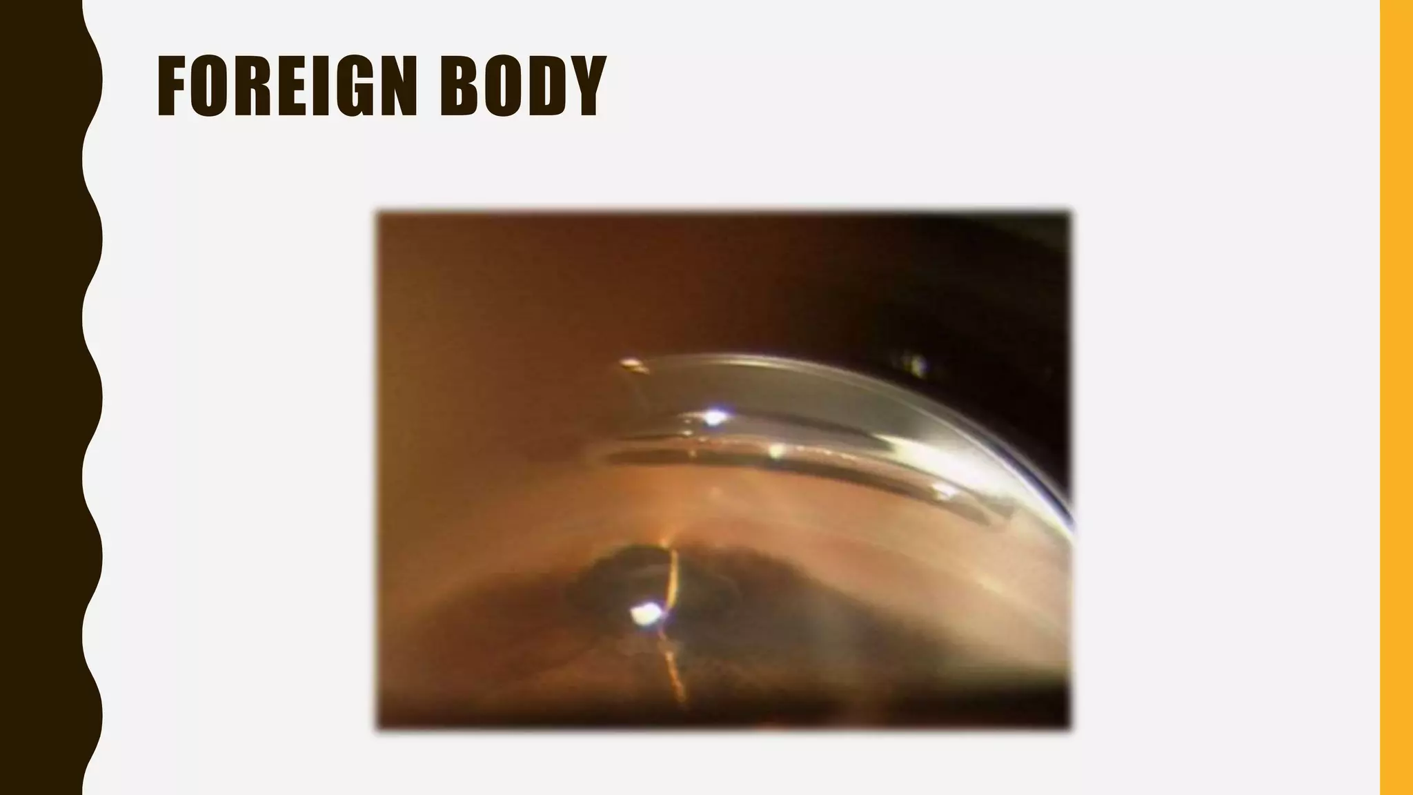 Gonioscopy | PPTX