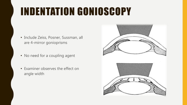 Gonioscopy | PPTX