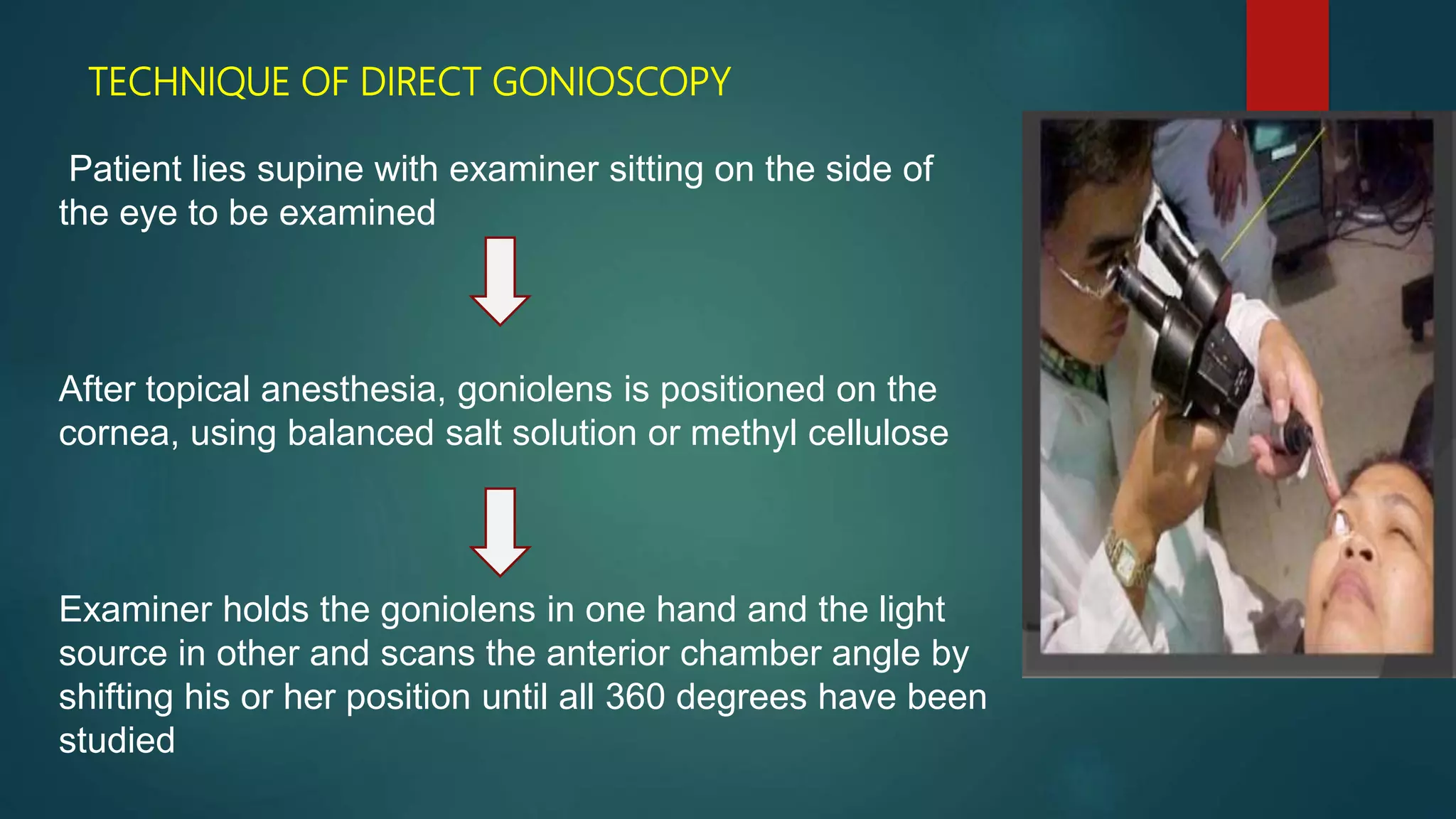 Gonioscopy | PPTX