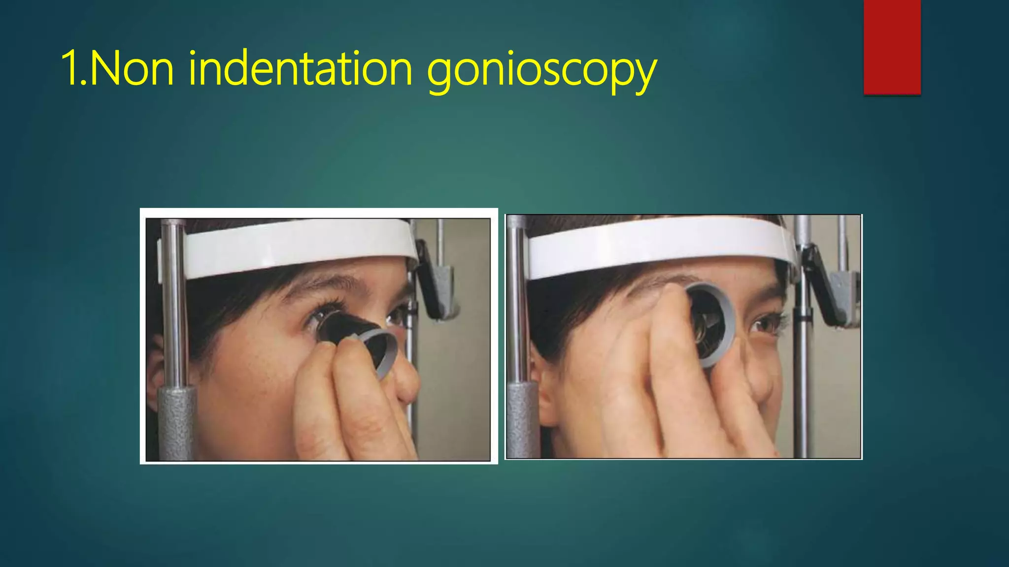 Gonioscopy | PPTX