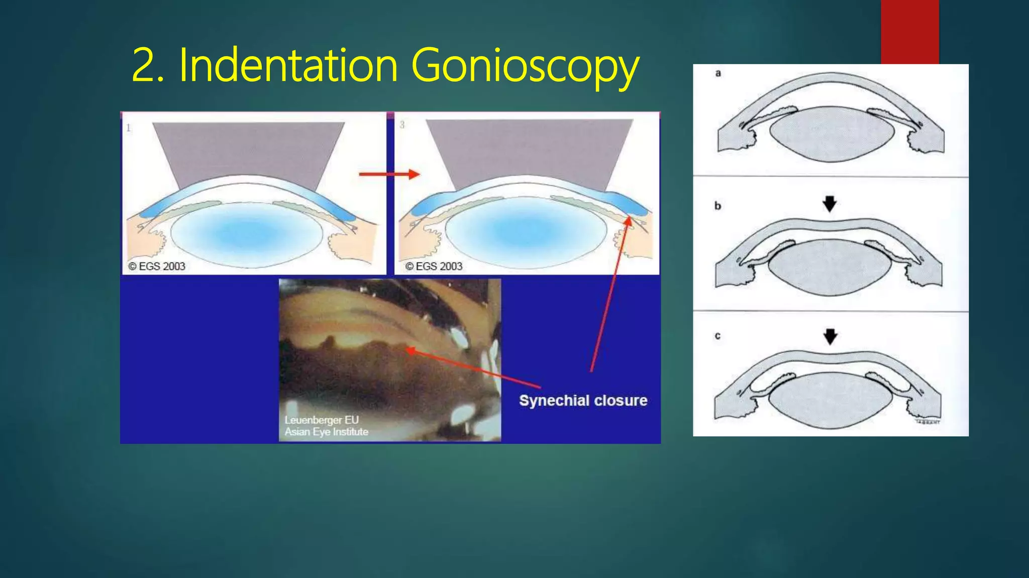 Gonioscopy | PPTX