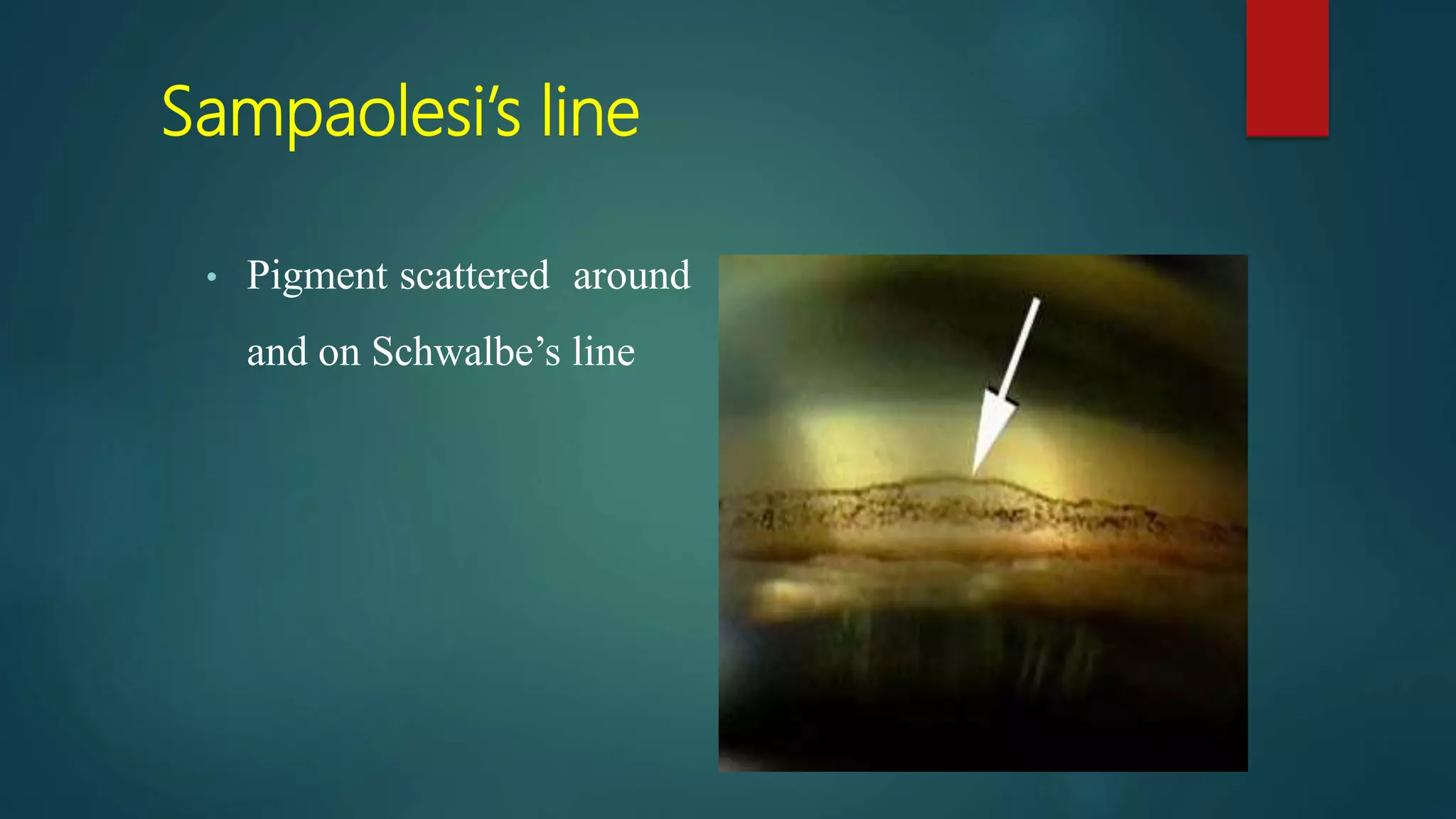 Gonioscopy | PPTX | Eye and Vision Conditions | Diseases and Conditions