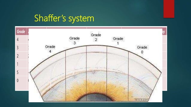 Gonioscopy | PPTX | Eye and Vision Conditions | Diseases and Conditions
