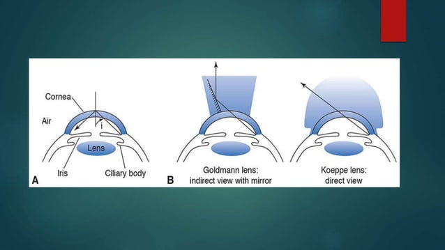 Gonioscopy | PPTX | Eye and Vision Conditions | Diseases and Conditions