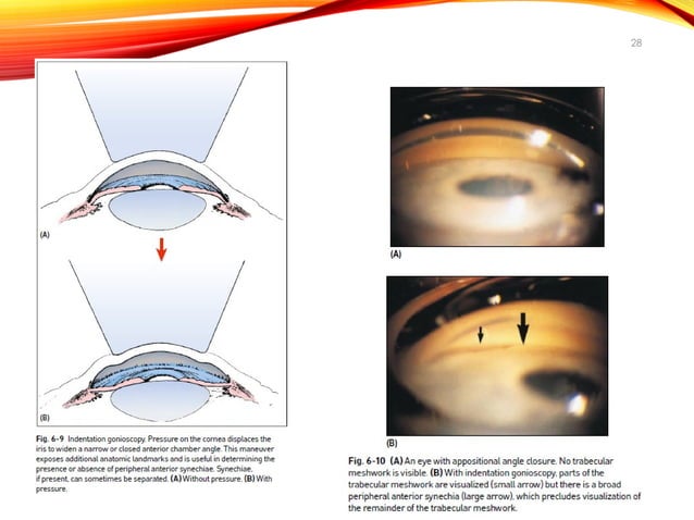 GONIOSCOPY TECHNIQUE AND INVESTIGATION.pptx