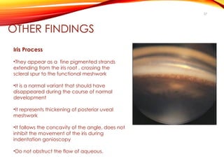 GONIOSCOPY TECHNIQUE AND INVESTIGATION.pptx