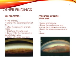 GONIOSCOPY TECHNIQUE AND INVESTIGATION.pptx
