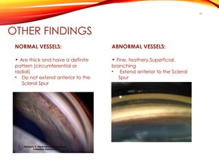 GONIOSCOPY TECHNIQUE AND INVESTIGATION.pptx