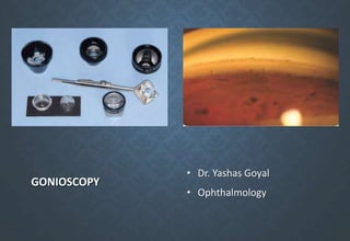 Gonioscopy | PPTX