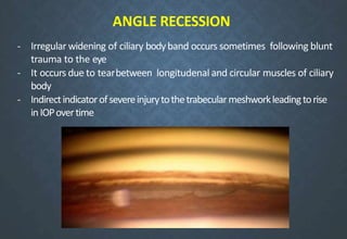 Gonioscopy Angle Recession