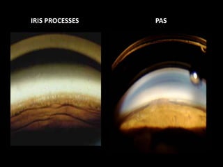 Iris Processes Gonioscopy Angle