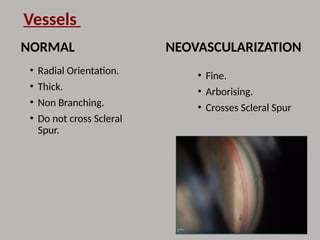 GONIOSCOPY By Dr. Niraj N. Goswami RIMS RAICHUR | PPTX