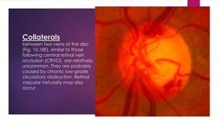 Gonioscopy and optic nerve head evaluation | PPTX