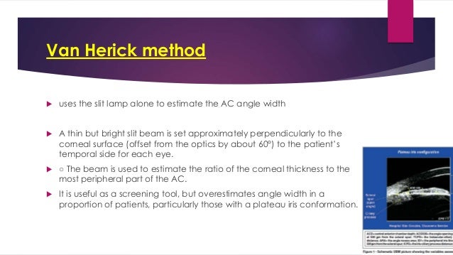 Gonioscopy and optic nerve head evaluation