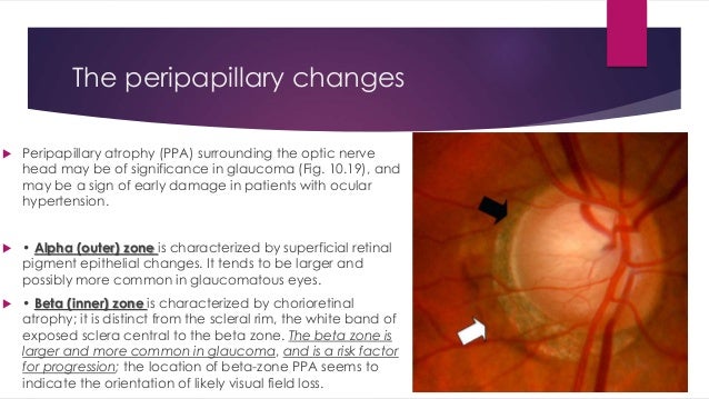 Gonioscopy and optic nerve head evaluation