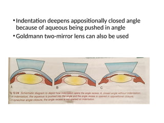 gonioscopy and its method and findings . | PPTX