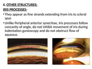 gonioscopy and its method and findings . | PPTX