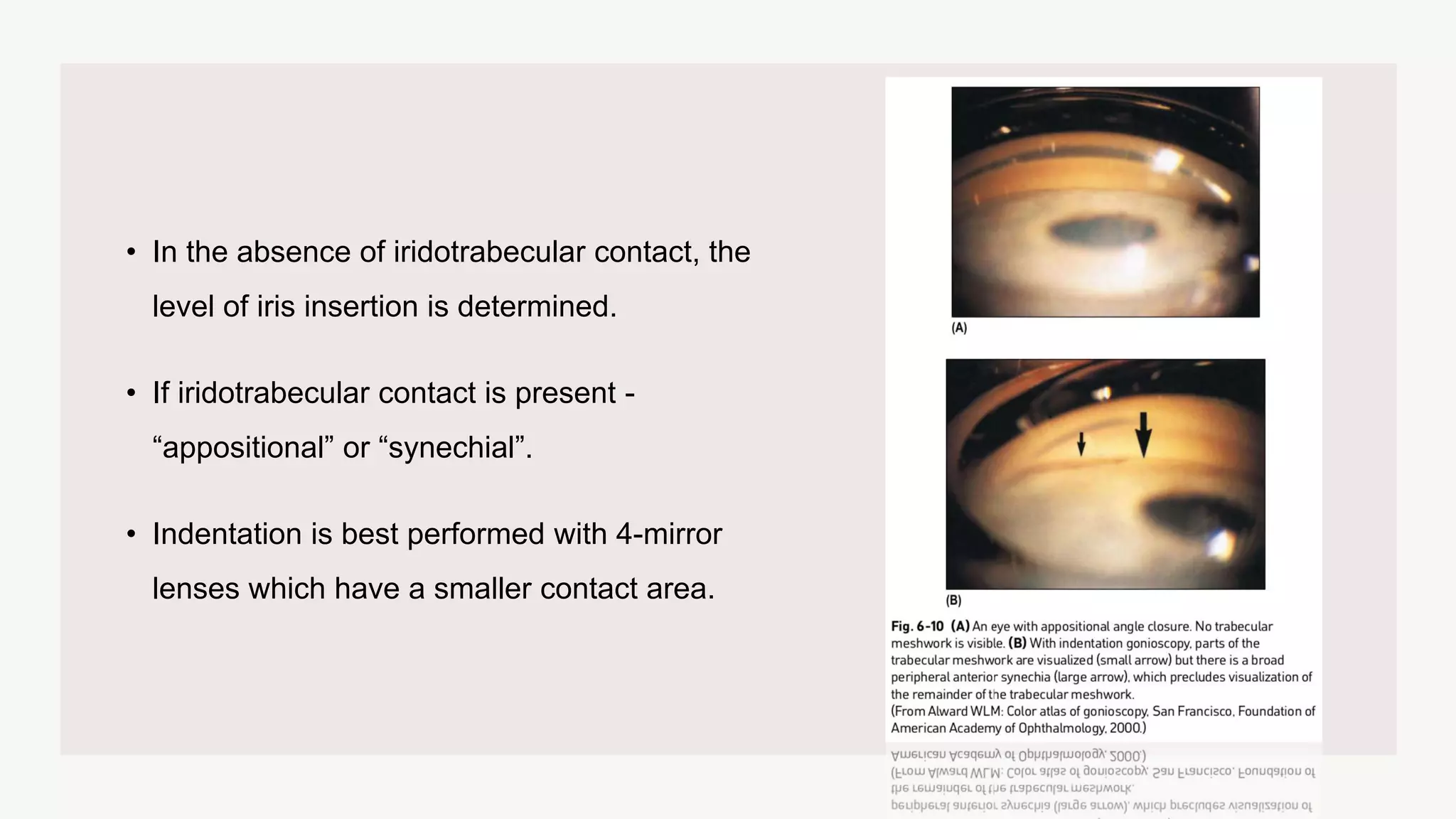 Gonioscopy | PPTX