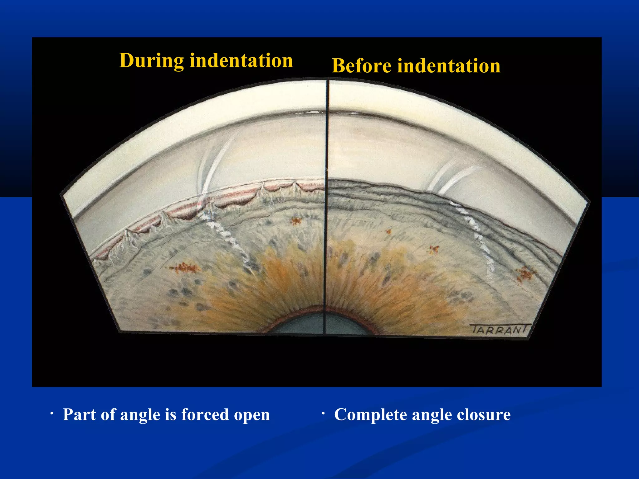 Gonioscopy presentation | PPT