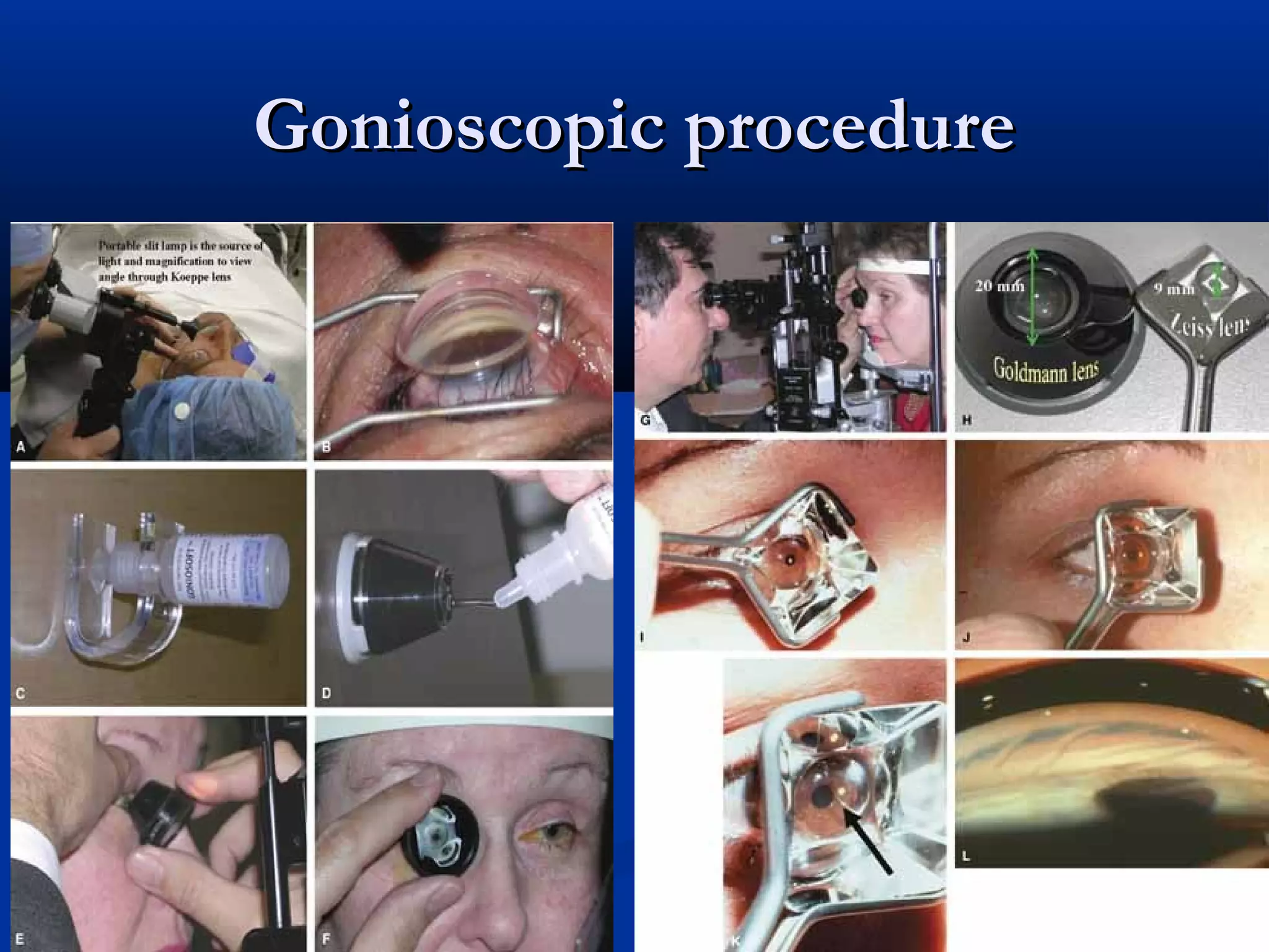 Gonioscopy presentation | PPT
