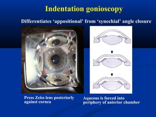 Gonioscopy presentation | PPT