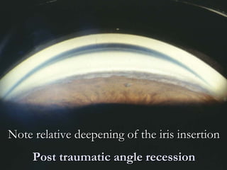 Recession Iris