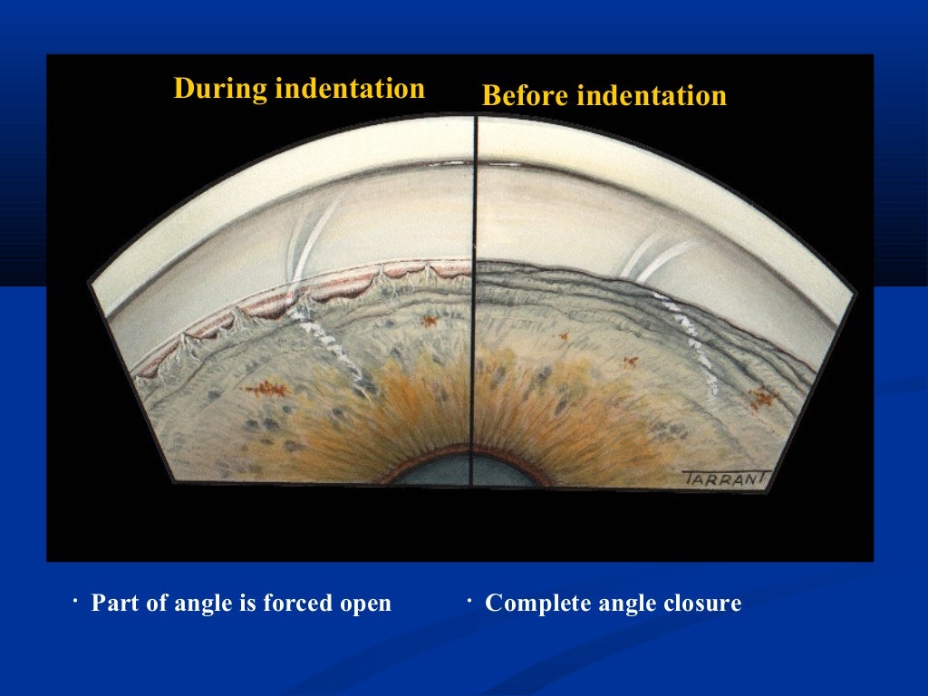 Gonioscopy presentation