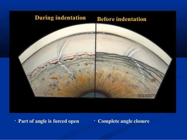 Gonioscopy presentation