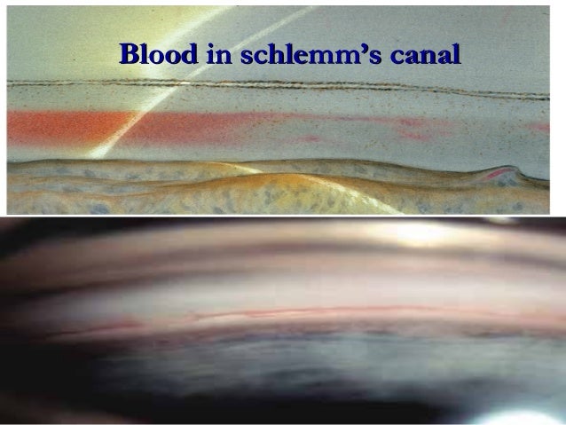 Gonioscopy presentation