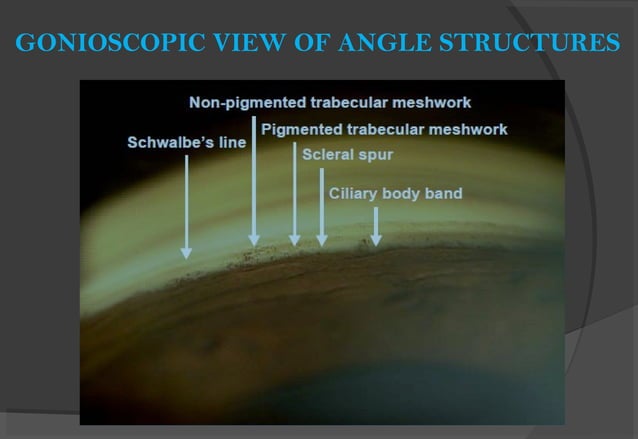 GONIOSCOPY by | PPT | Eye and Vision Conditions | Diseases and Conditions