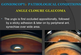 GONIOSCOPY by | PPT