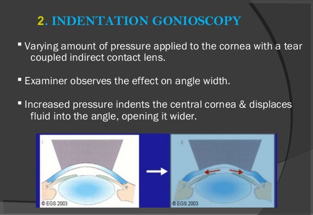 GONIOSCOPY by