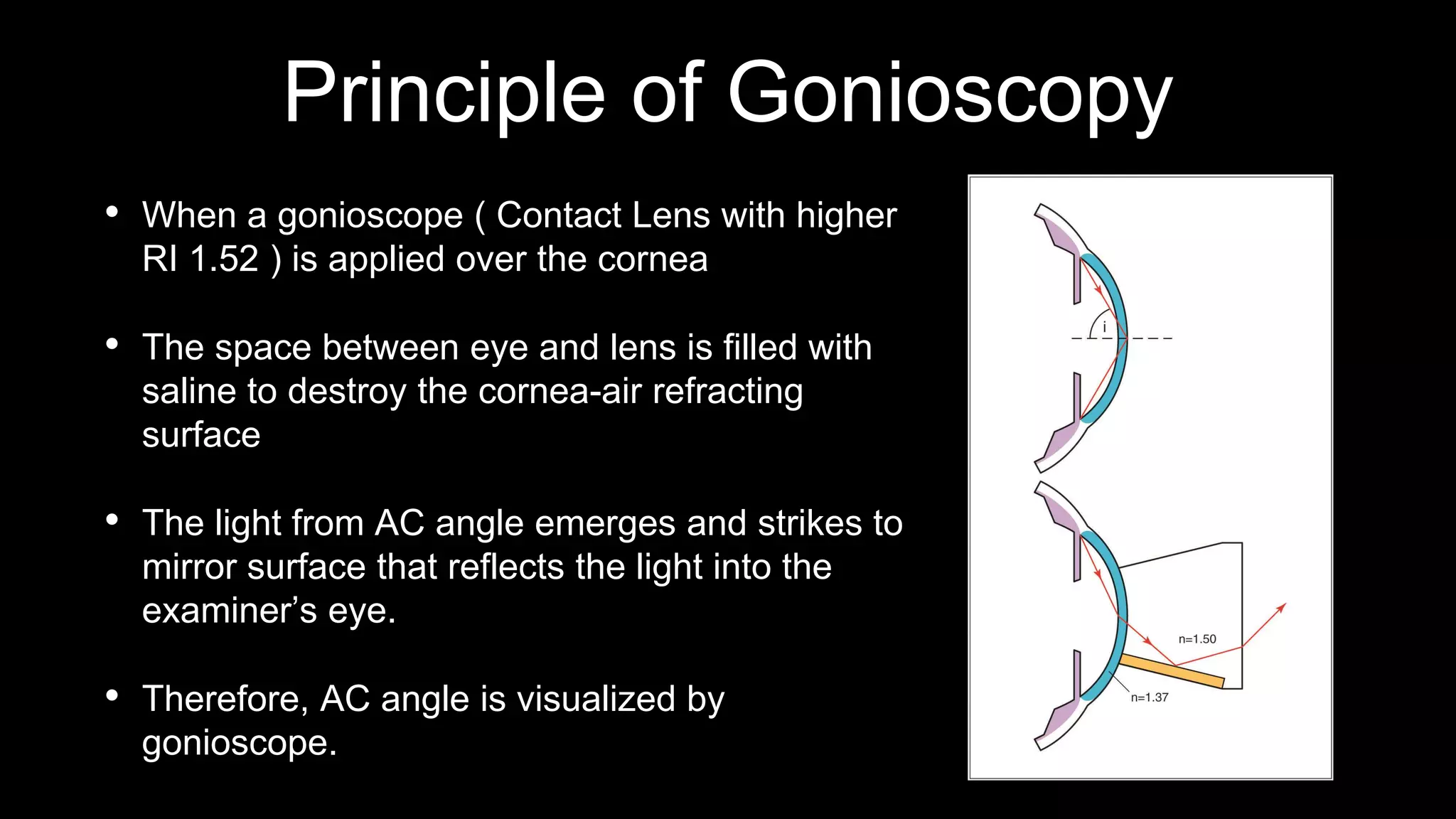 GONIOSCOPY by Dr. ZAW MIN HTET (OPHTHALMOLOGIST) | PPTX