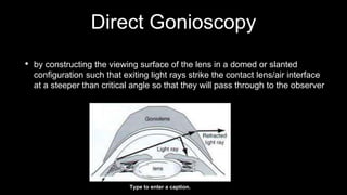GONIOSCOPY by Dr. ZAW MIN HTET (OPHTHALMOLOGIST) | PPTX