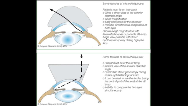 GONIOSCOPY by Dr. ZAW MIN HTET (OPHTHALMOLOGIST) | PPTX | Eye and ...