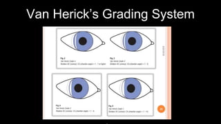 GONIOSCOPY by Dr. ZAW MIN HTET (OPHTHALMOLOGIST) | PPTX