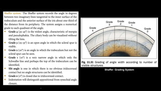GONIOSCOPY by Dr. ZAW MIN HTET (OPHTHALMOLOGIST) | PPTX
