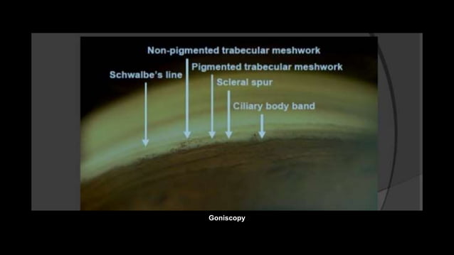 GONIOSCOPY by Dr. ZAW MIN HTET (OPHTHALMOLOGIST) | PPTX | Eye and ...