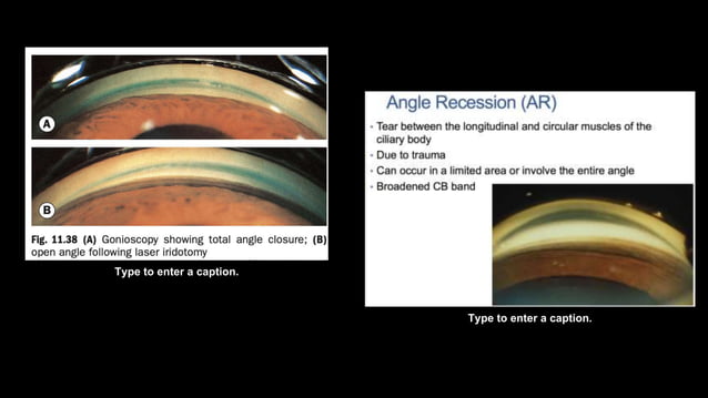 GONIOSCOPY by Dr. ZAW MIN HTET (OPHTHALMOLOGIST) | PPTX | Eye and Vision Conditions | Diseases ...