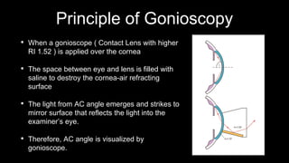 GONIOSCOPY by Dr. ZAW MIN HTET (OPHTHALMOLOGIST) | PPTX