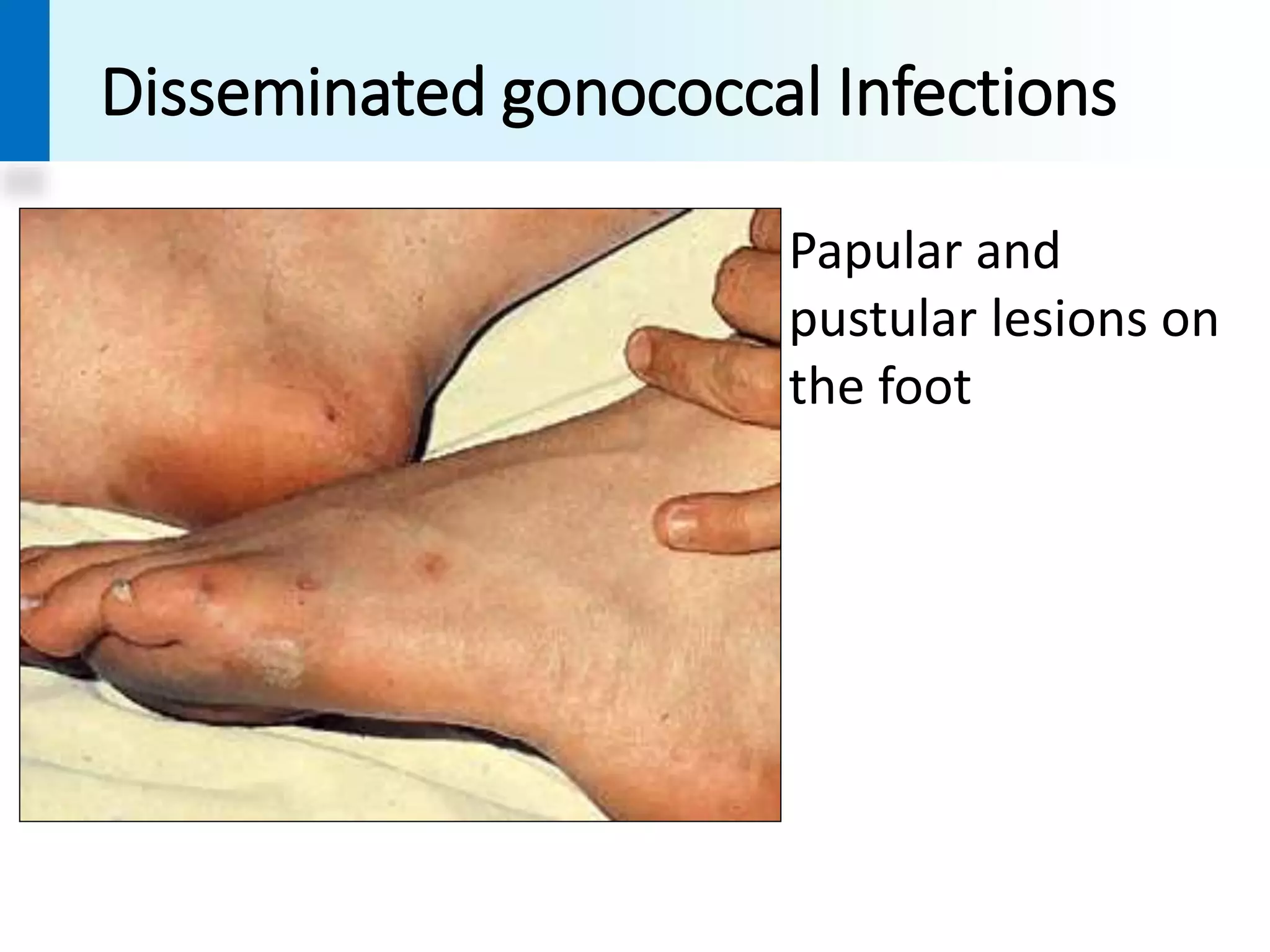 Gonococci | PDF