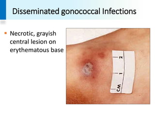 Gonococci | PDF