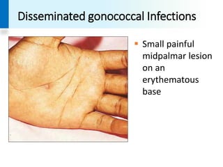 Gonococci | PDF