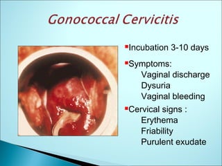 Cervix With Gonorrhea