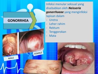 Gonorrhea | PPTX