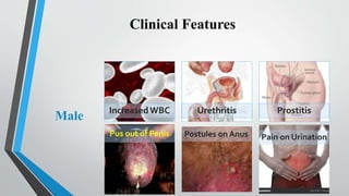 Gonorrhea | PPTX