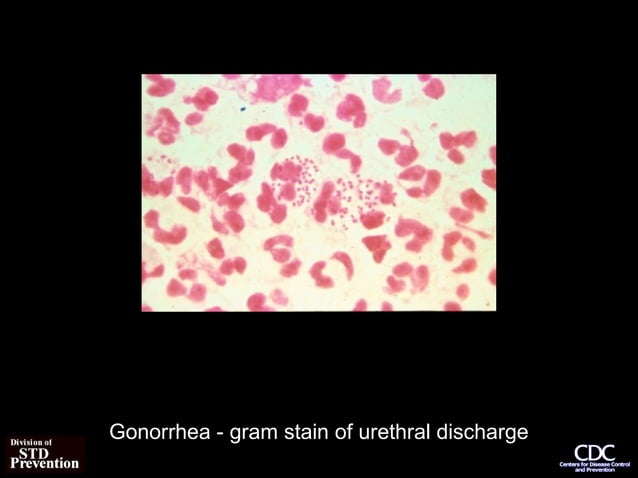 gonorrhea.ppt..introduction with images and diagnosis treatment | PPT