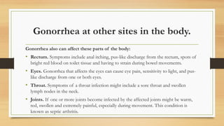 Simple understanding of Gonorrhea and it's management | PPT