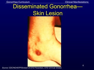Disseminated Gonorrhea Rash